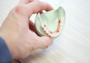 Subperiosteal Dental Implants | Pros and Cons | 4M Dental Implant Center