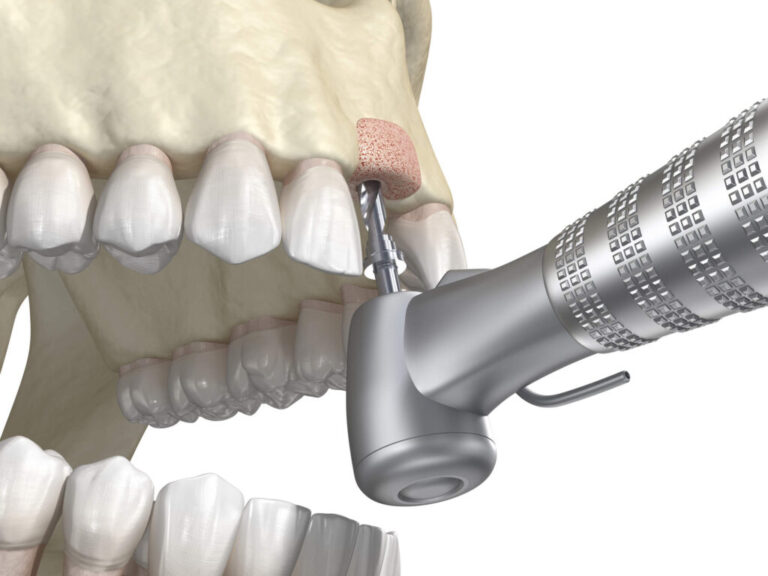 Bone Grafting to Restore Implant Success | 4M Dental Implant Center