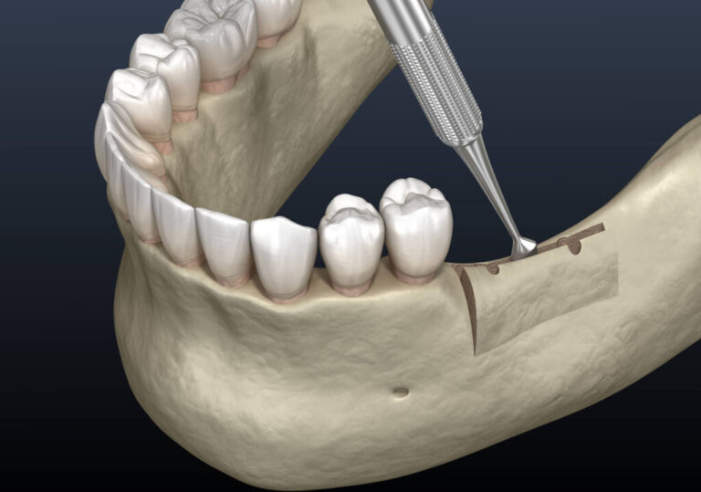 Bone Loss Restoration & Dental Implants | 4M Dental Implant Center