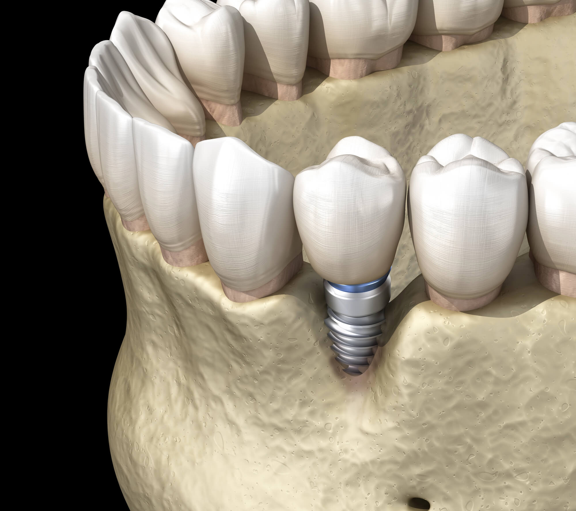 Minimally Invasive Dental Implant Revision Options