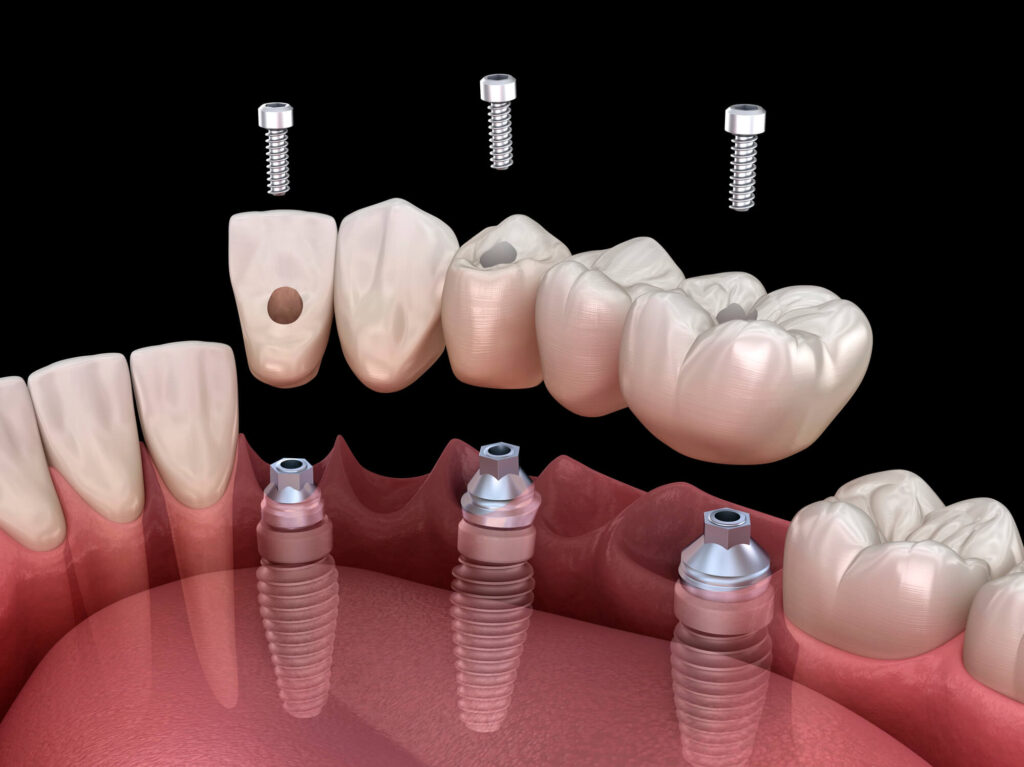 Durability of Titanium Dental Implants: What You Need to Know - 4M Dental