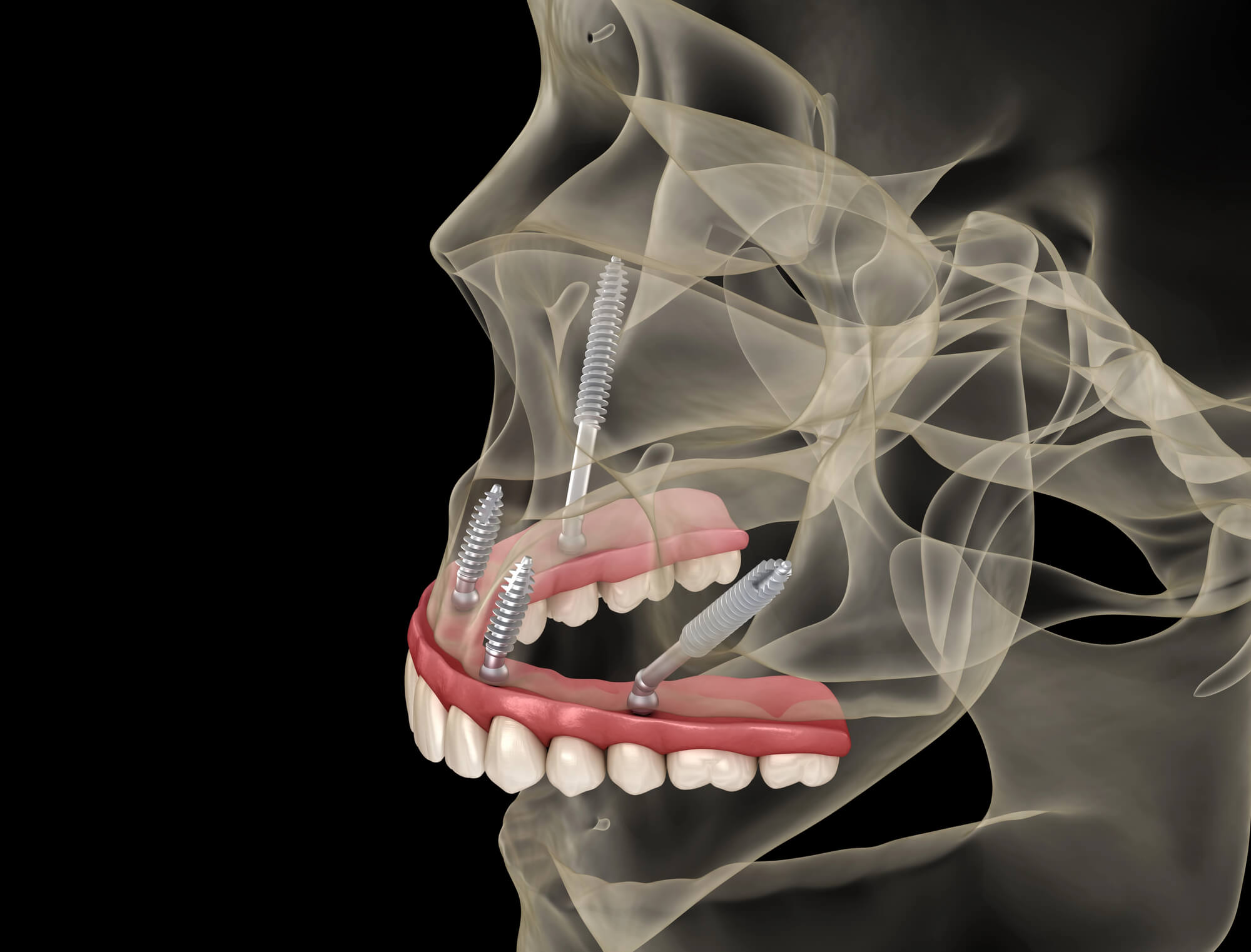 Understanding Zygomatic Implants for Severe Bone Loss - 4M Dental